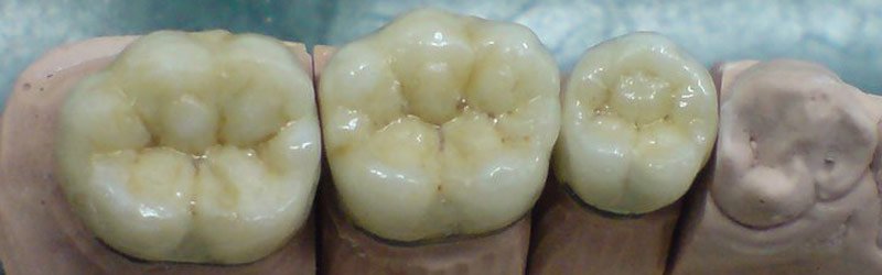 Prótesis dentales a medida | IMPRODENT 3000